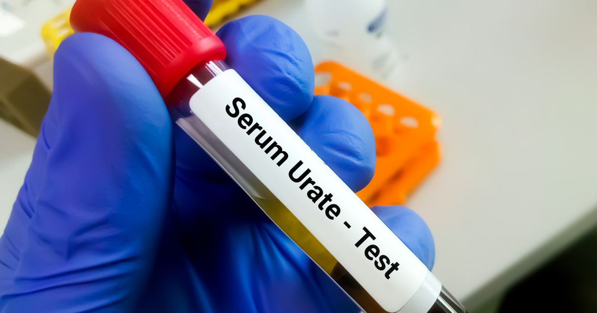 Što su urati u krvi i koje namirnice pomažu kad su povišeni? | Telegram.hr