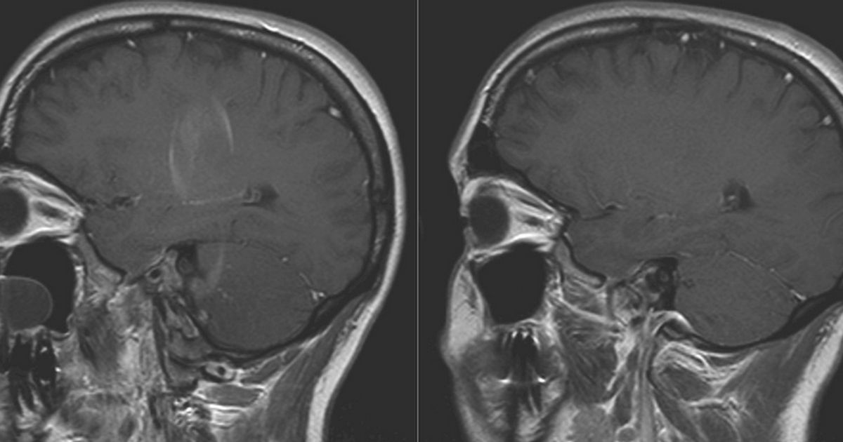 Jedno MRI istraživanje otkrilo je zbog čega nam neke pjesme ne izlaze ...