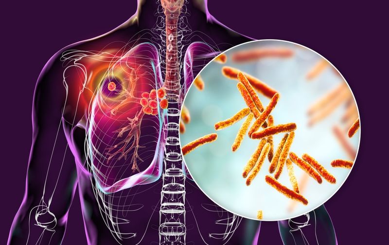 Tuberkuloza: Kako se prenosi, je li izlječiva i koje simptome ima ...