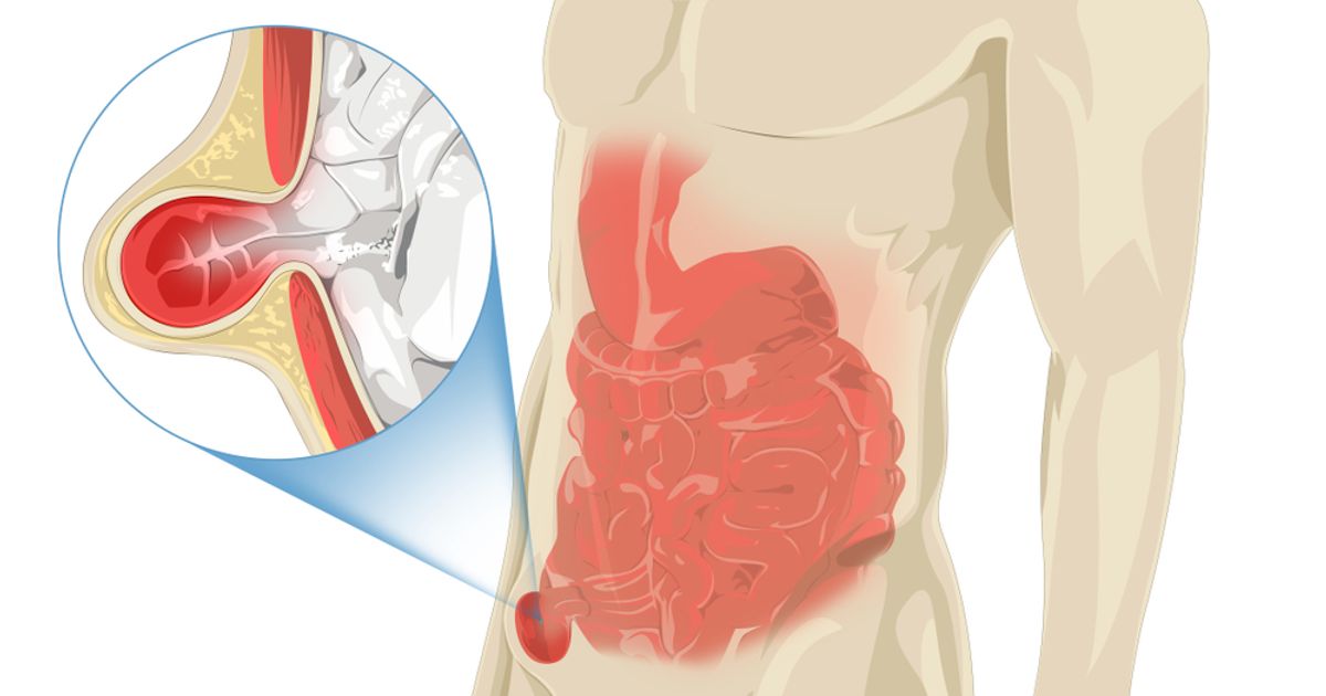 Preponska kila: Simptomi, liječenje i gdje kupiti pojas? | Telegram.hr
