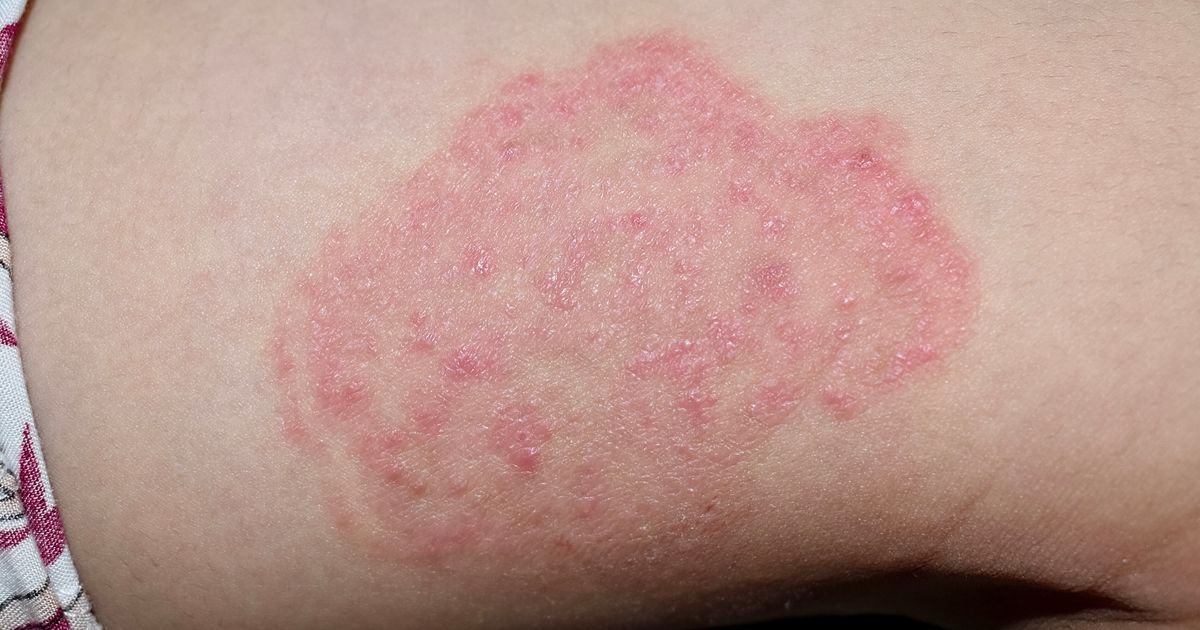 Lišaj na koži: kako ga prepoznati i liječiti? | Telegram.hr