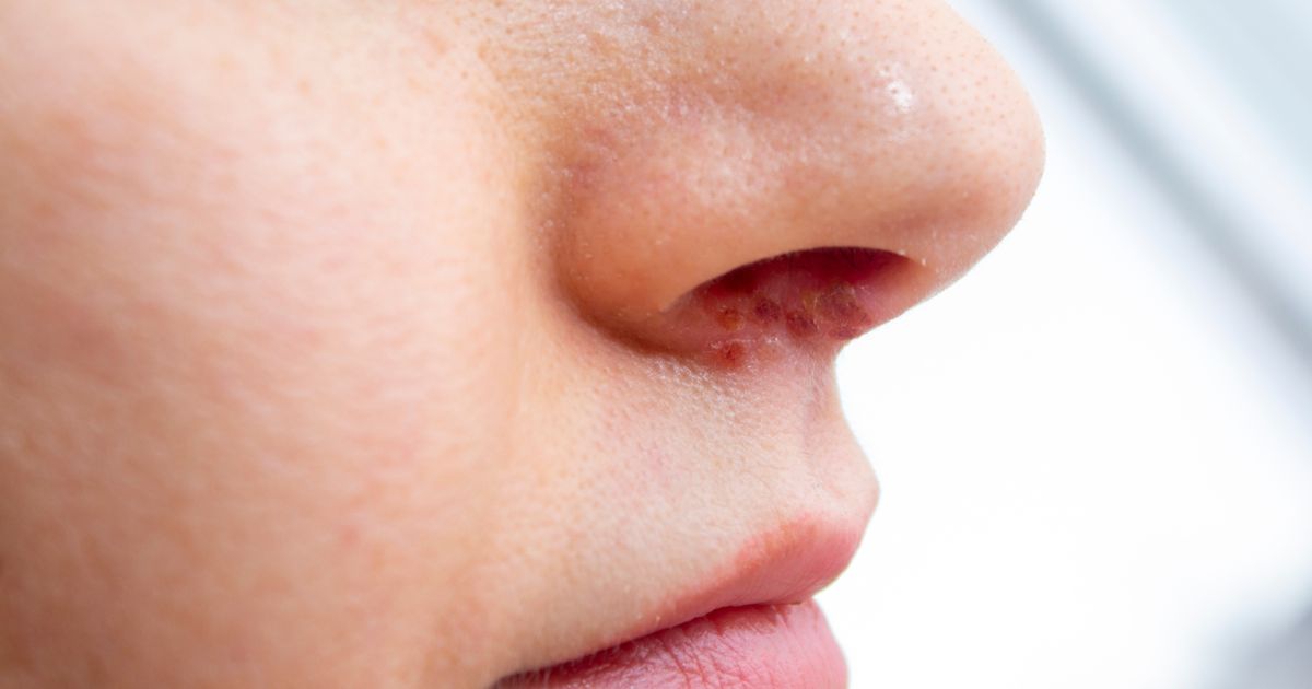 Herpes u nosu: Što ga uzrokuje i kako ga brzo zaliječiti? | Telegram.hr
