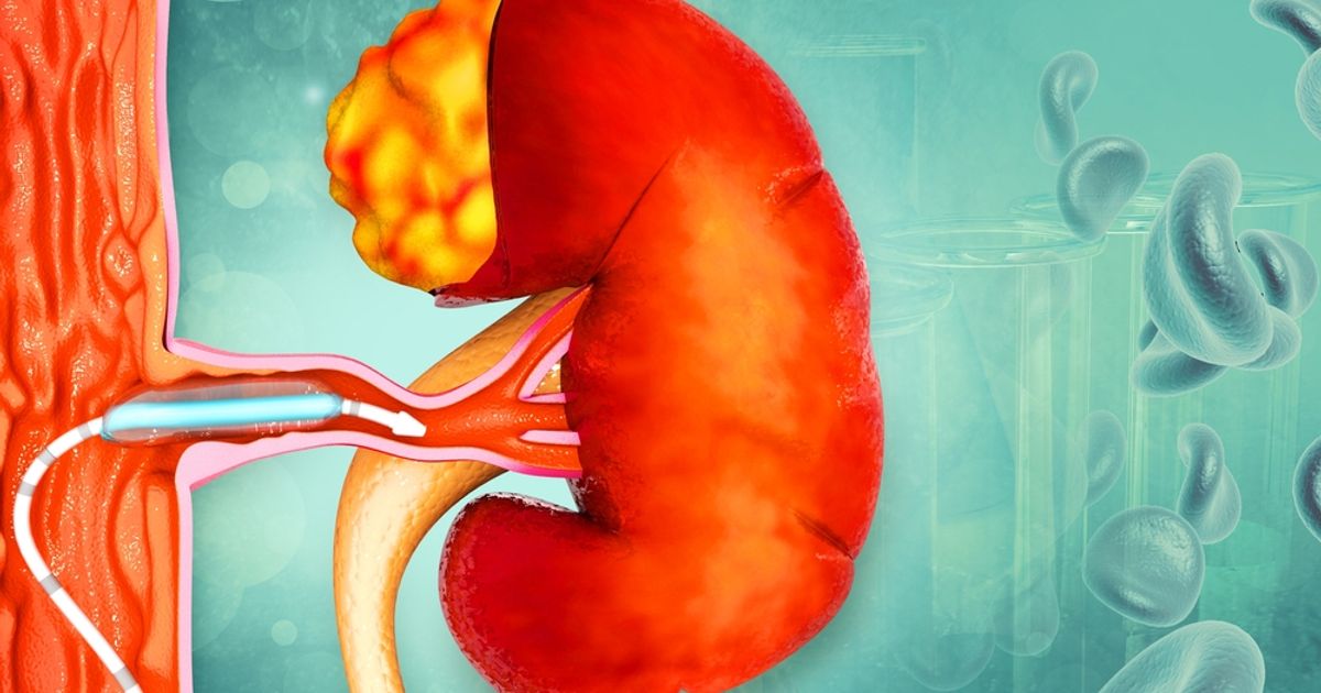 JJ stent: kako izgleda ugradnja proteze i koliko traje oporavak ...