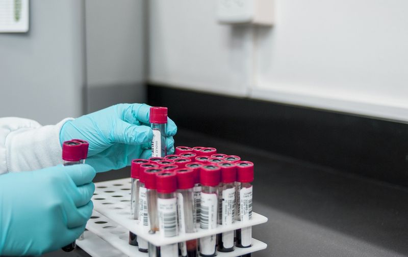 PSA test: Normalne vrijednosti i kako se pripremiti za test? | Telegram.hr