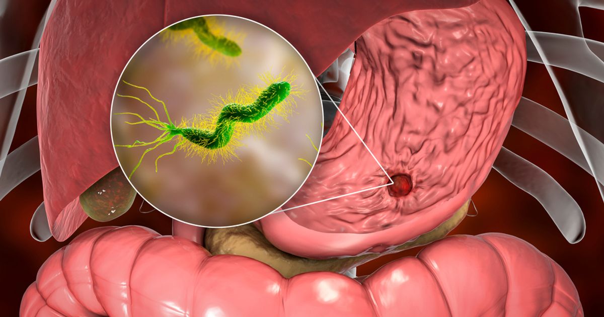 Heliko bakterija: Simptomi, kako se prenosi i je li izlječiva ...